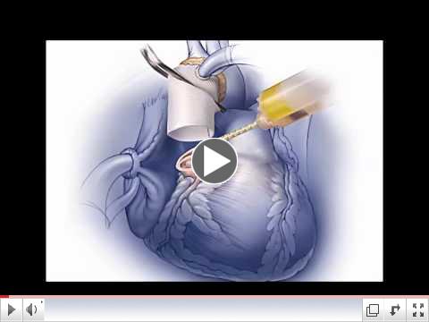 CryoLife BioGlue Surgical Adhesive